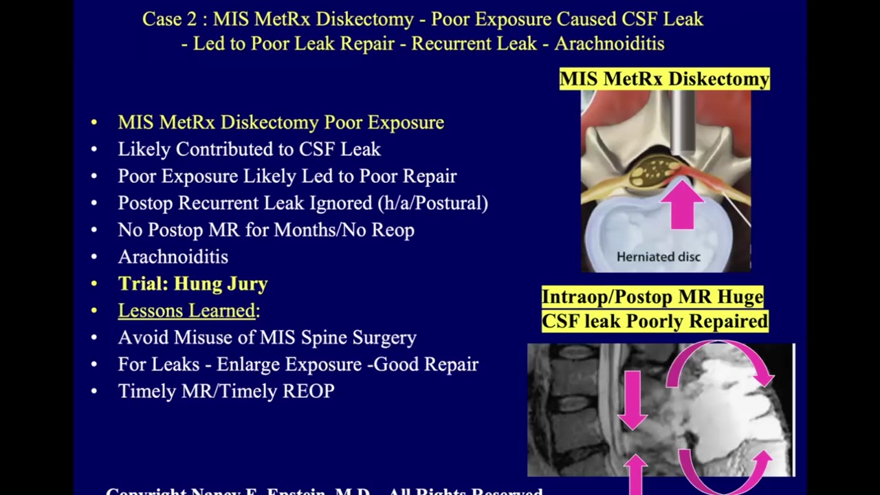 Negligent Lumbar SPINE SURGERY -LEARNING FROM ACTUAL CASES